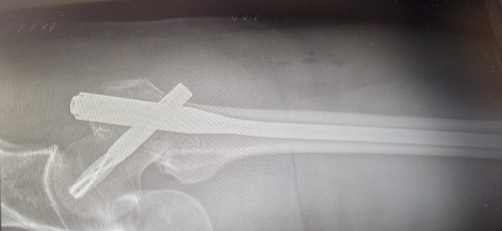 Fragility Fracture Network: Nyt netværk for sundhedsfaglige ...